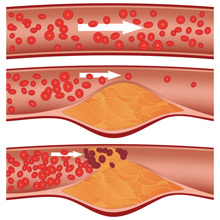 Dangers of Fat in Your Blood Vessels ...